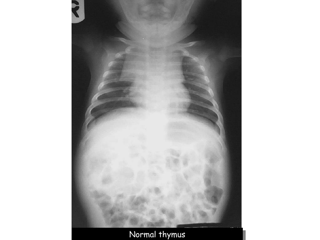 PPT - Pediatric Radiology for R a ngsit medical students PowerPoint ...