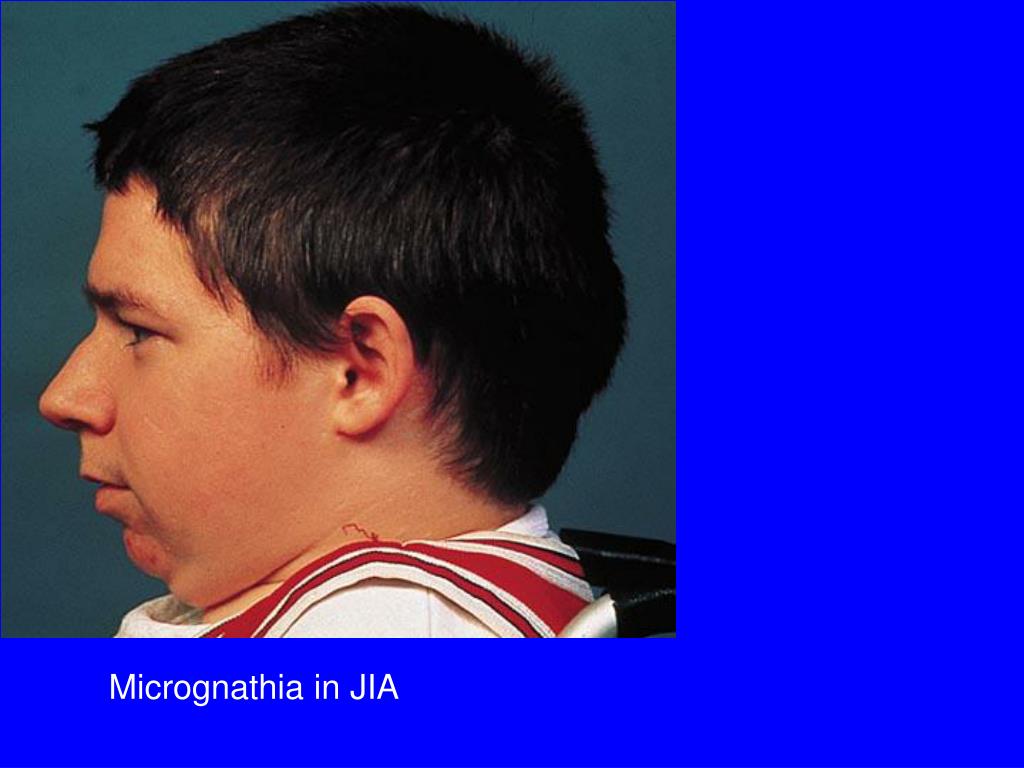 PPT - RHEUMATOID ARTHRITIS (RA) PowerPoint Presentation, free download ...