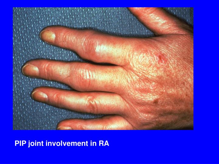 PPT - RHEUMATOID ARTHRITIS (RA) PowerPoint Presentation - ID:1740166