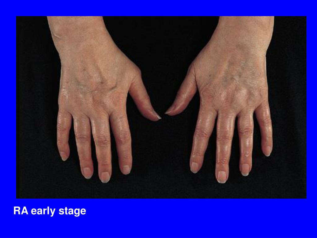 PPT - RHEUMATOID ARTHRITIS (RA) PowerPoint Presentation, free download ...