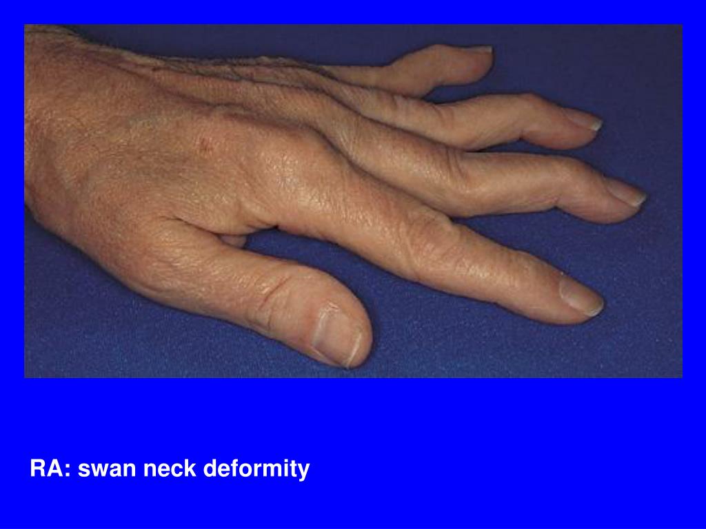 PPT - RHEUMATOID ARTHRITIS (RA) PowerPoint Presentation, free download ...
