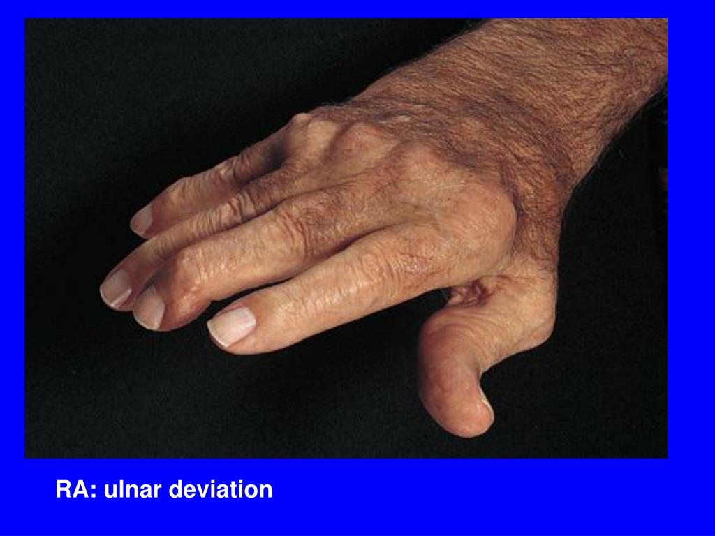 PPT - RHEUMATOID ARTHRITIS (RA) PowerPoint Presentation, free download ...