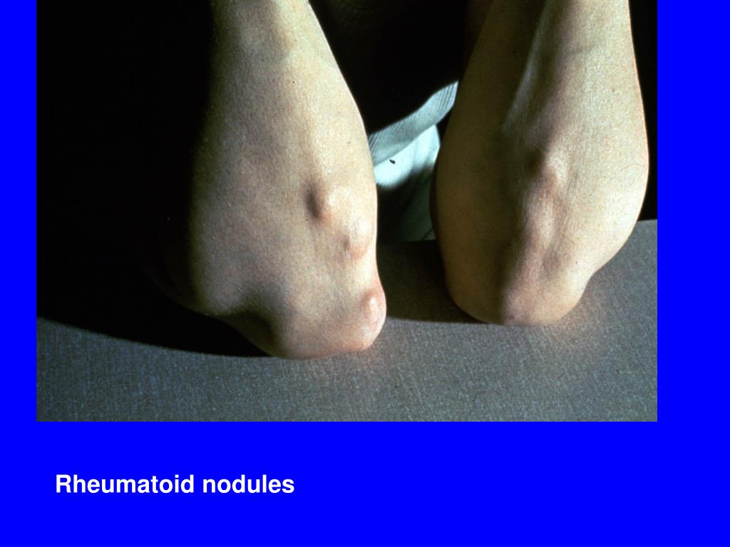 PPT - RHEUMATOID ARTHRITIS (RA) PowerPoint Presentation, free download ...
