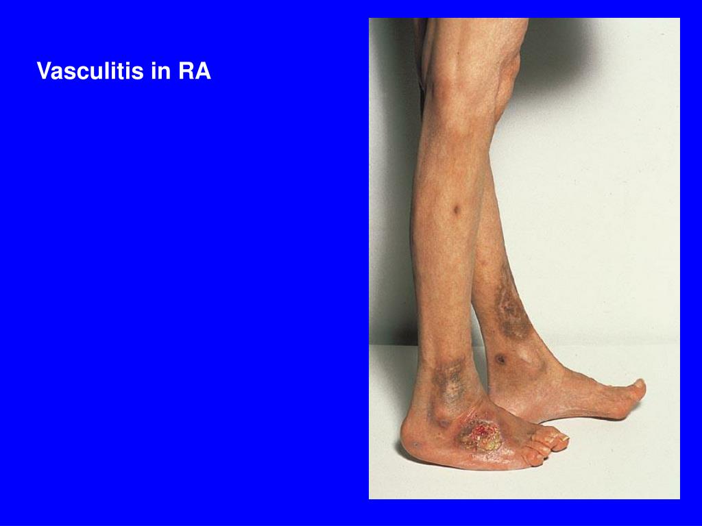 PPT - RHEUMATOID ARTHRITIS (RA) PowerPoint Presentation, free download ...