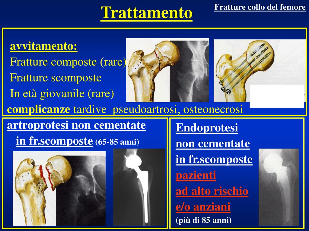 PPT - Fratture dell’arto inferiore PowerPoint Presentation, free ...