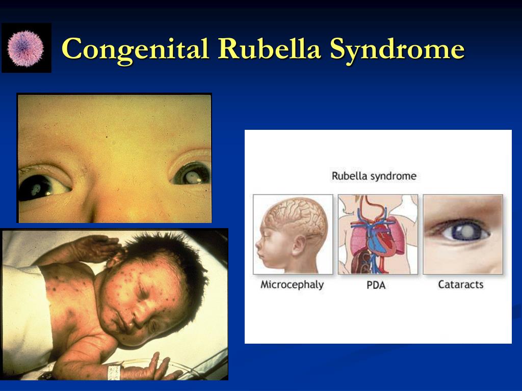 PPT - Childhood Infectious Diseases PowerPoint Presentation, free ...