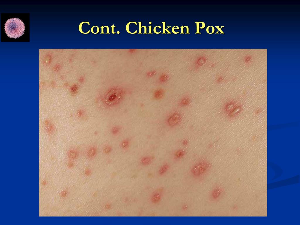 PPT - Childhood Infectious Diseases PowerPoint Presentation, free ...