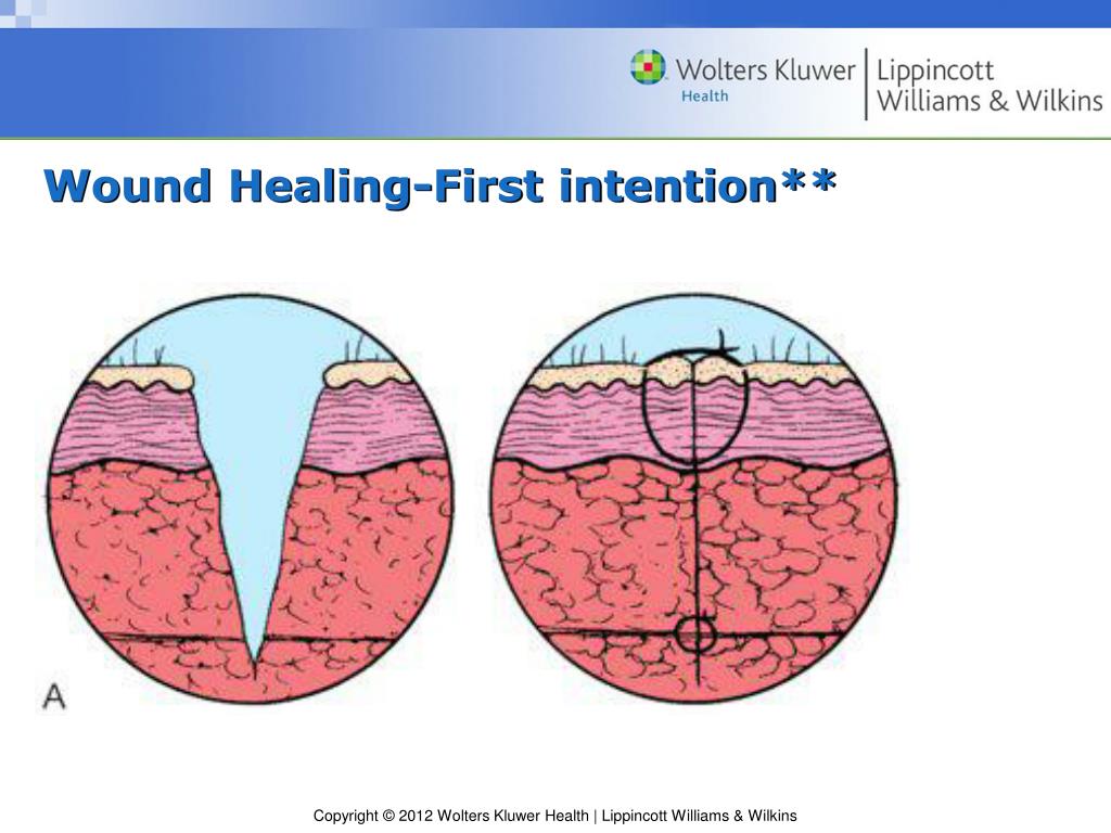 PPT - Chapter 58 Special Skin and Wound Care PowerPoint Presentation ...