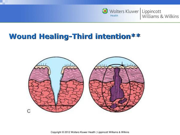 PPT - Chapter 58 Special Skin and Wound Care PowerPoint Presentation ...