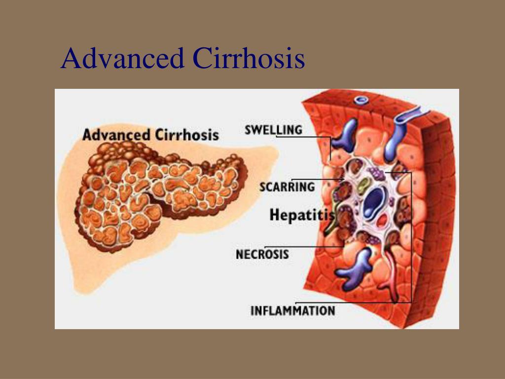 PPT - Nursing Care of Clients with Gallbladder, Liver and Pancreatic ...