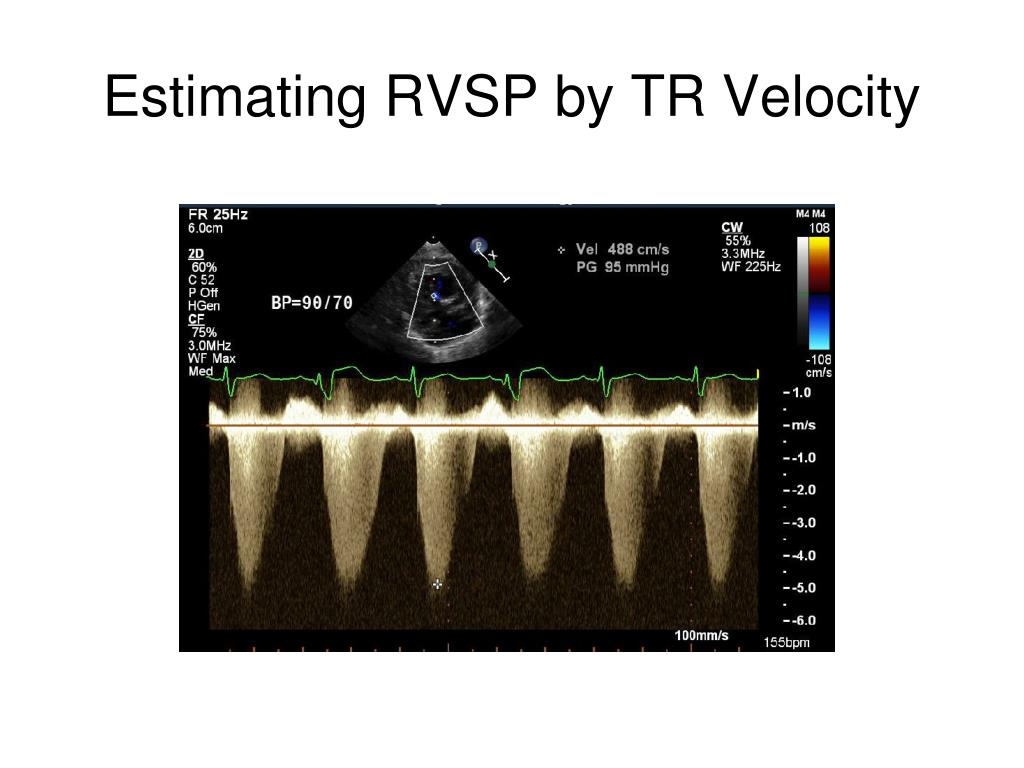 PPT - Pulmonary Hypertension: The Other High Blood Pressure PowerPoint ...
