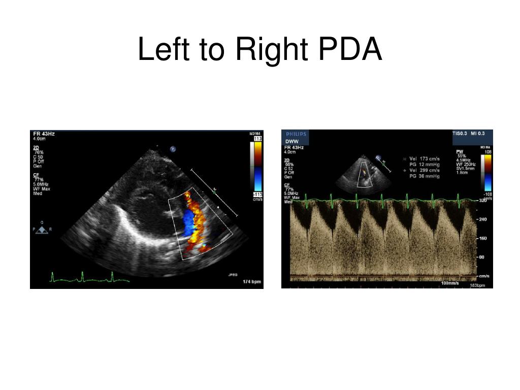 PPT - Pulmonary Hypertension: The Other High Blood Pressure PowerPoint ...