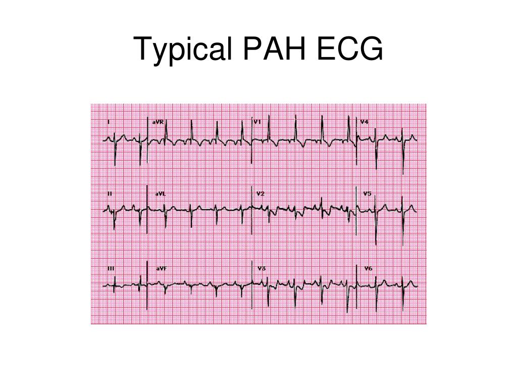 PPT - Pulmonary Hypertension: The Other High Blood Pressure PowerPoint ...