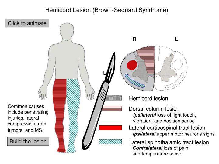 PPT - EXTRAPYRAMIDAL TRACTS & MOTOR NEURON LESIONS PowerPoint ...
