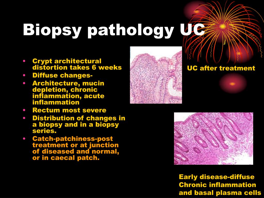 PPT - Aetiology and Pathology of Inflammatory Bowel Disease. PowerPoint ...
