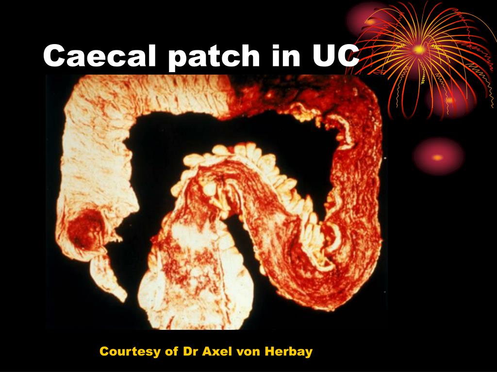 PPT - Aetiology and Pathology of Inflammatory Bowel Disease. PowerPoint ...