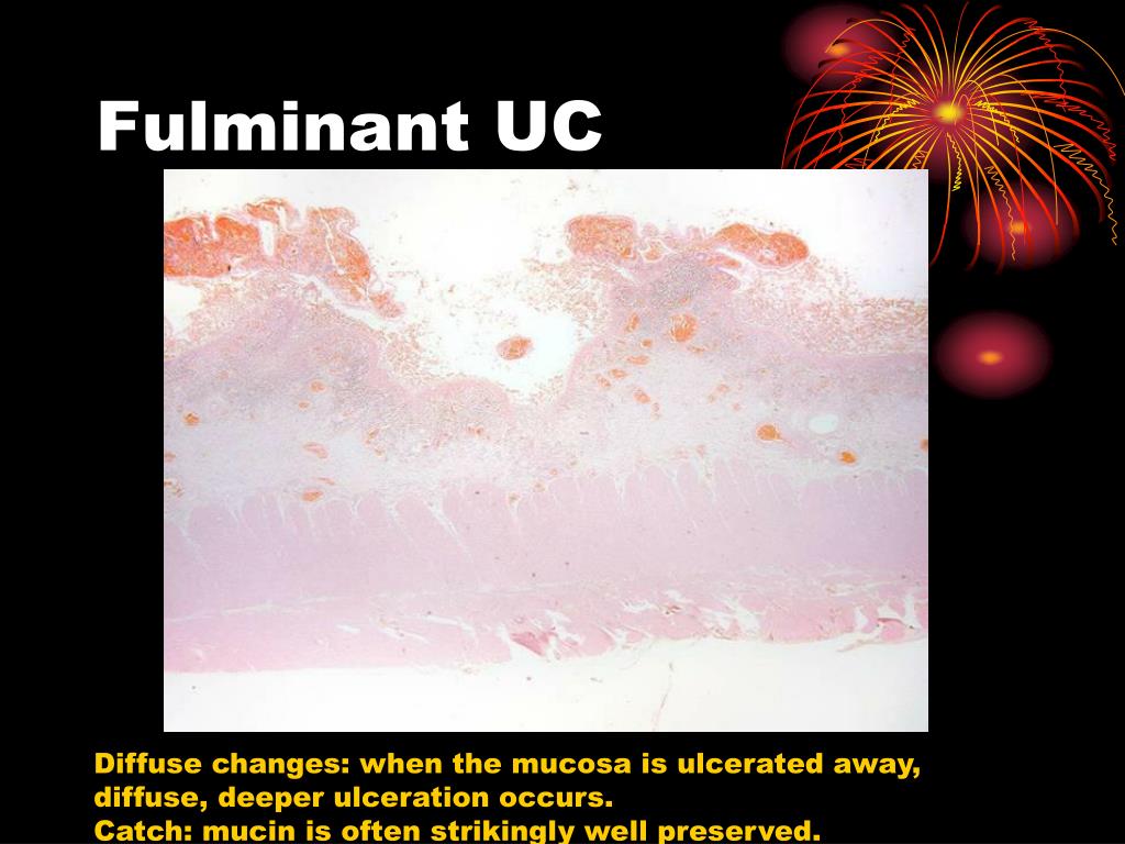 PPT - Aetiology and Pathology of Inflammatory Bowel Disease. PowerPoint ...
