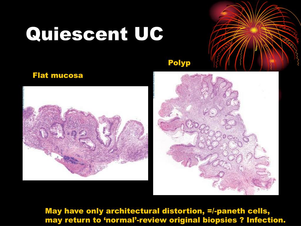 PPT - Aetiology and Pathology of Inflammatory Bowel Disease. PowerPoint ...