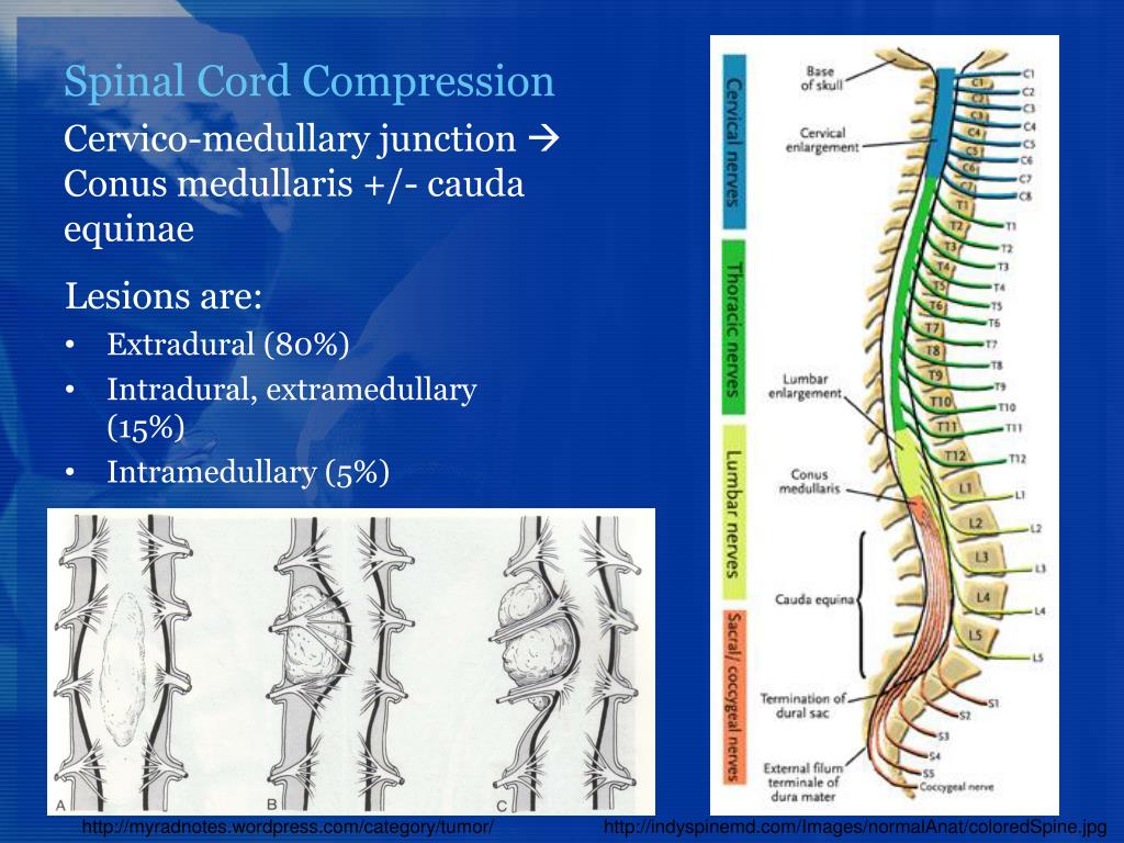 Causes And Treatment Of Spinal Cord Compression Check - vrogue.co Causes And Treatment Of Spinal Cord Compression Check - vrogue.co