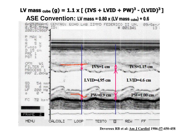 PPT - LVH Criteria PowerPoint Presentation - ID:1767430