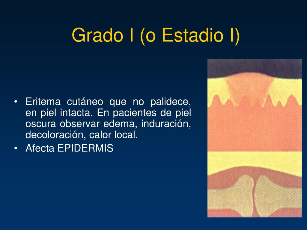PPT - Cuidados de Enfermería en las Úlceras por Presión PowerPoint ...