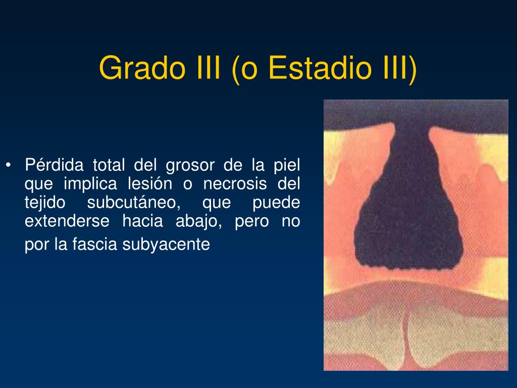 PPT - Cuidados de Enfermería en las Úlceras por Presión PowerPoint ...