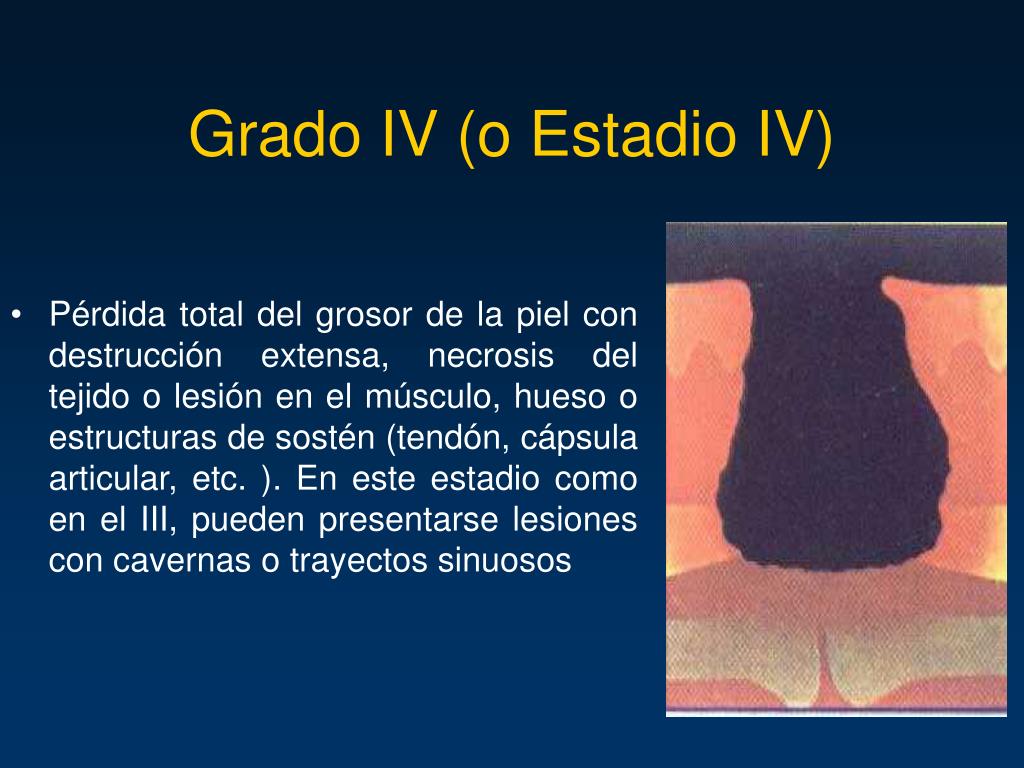 PPT - Cuidados de Enfermería en las Úlceras por Presión PowerPoint ...