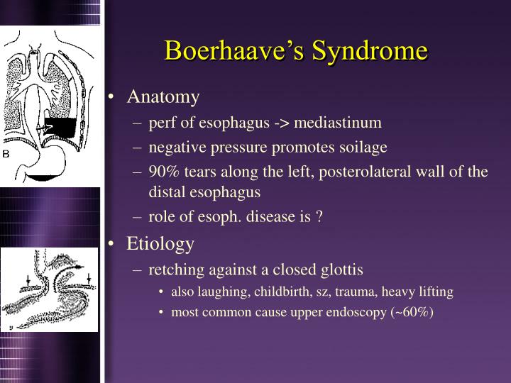PPT - Boerhaave’s Syndrome PowerPoint Presentation - ID:1769909