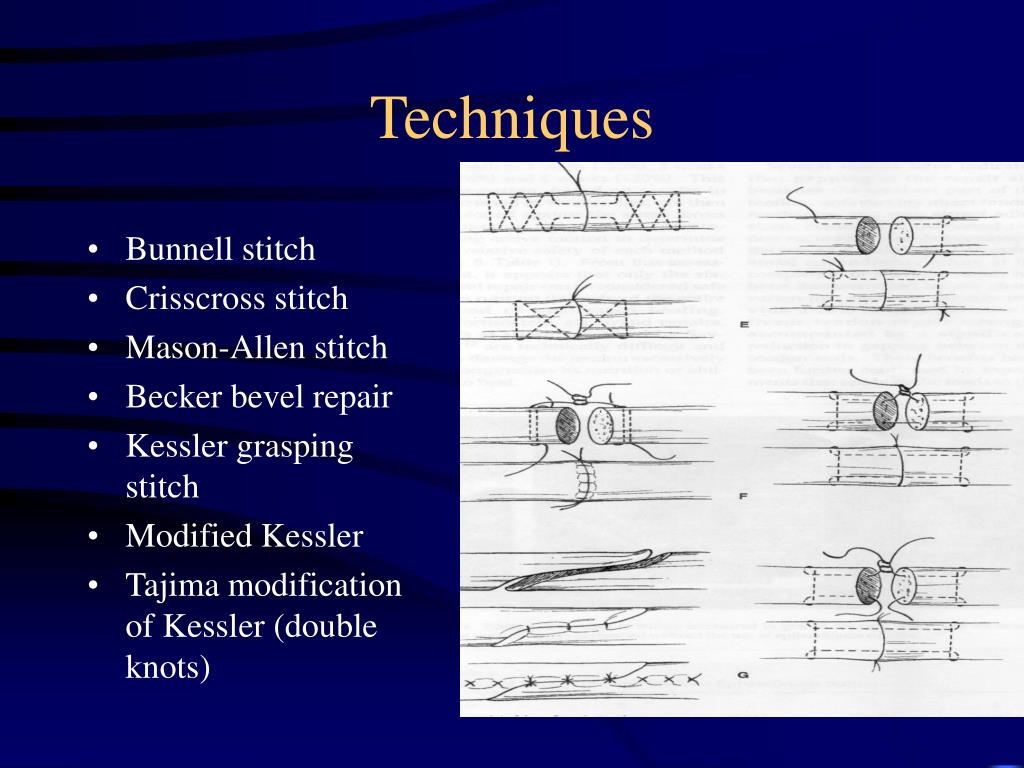 PPT - FLEXOR TENDON INJURIES James M. Steinberg D.O. Garden City ...