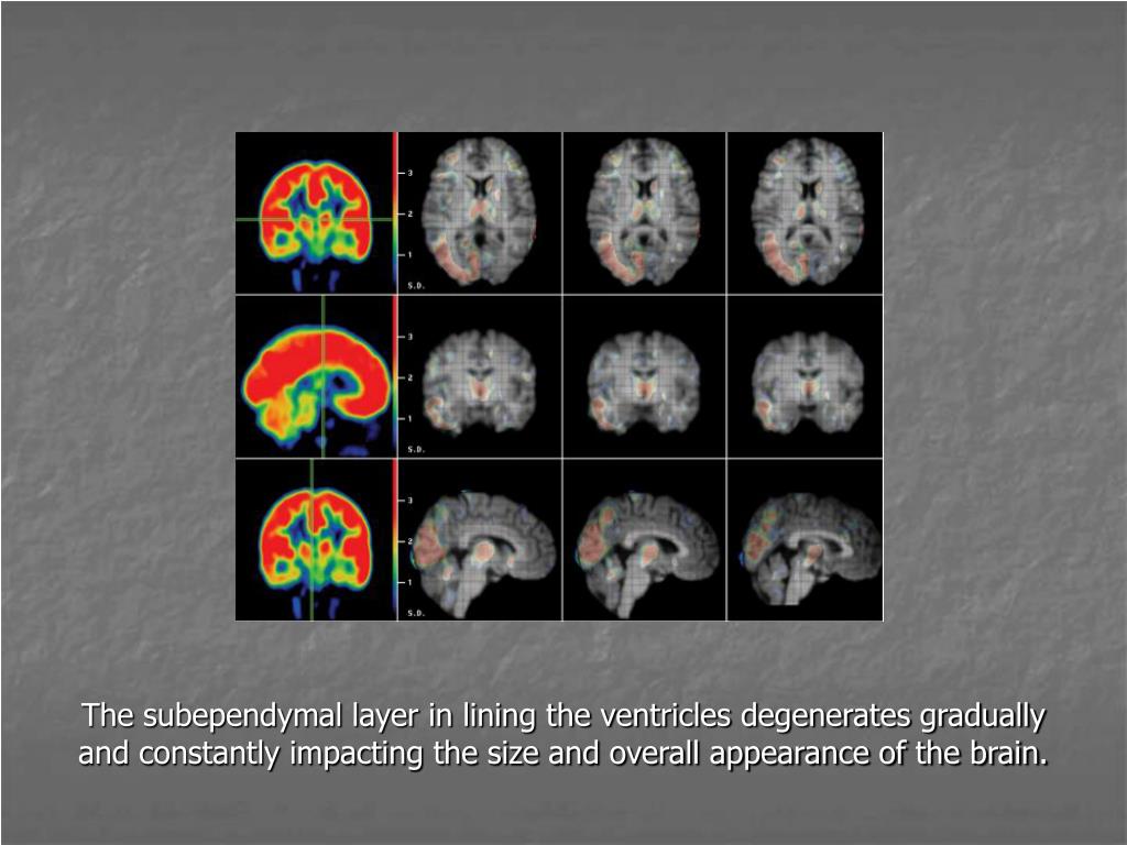 PPT - Huntington’s Disease PowerPoint Presentation, free download - ID ...