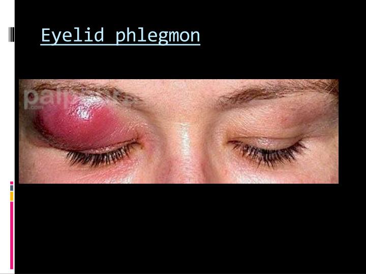 PPT - phlegmon PowerPoint Presentation - ID:1776565