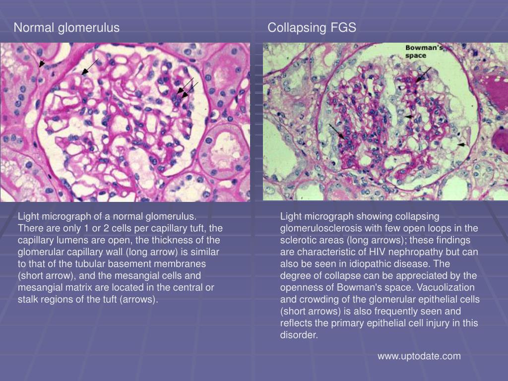 PPT - HIV Associated Nephropathy PowerPoint Presentation, free download ... PPT - HIV Associated Nephropathy PowerPoint Presentation, free download ...