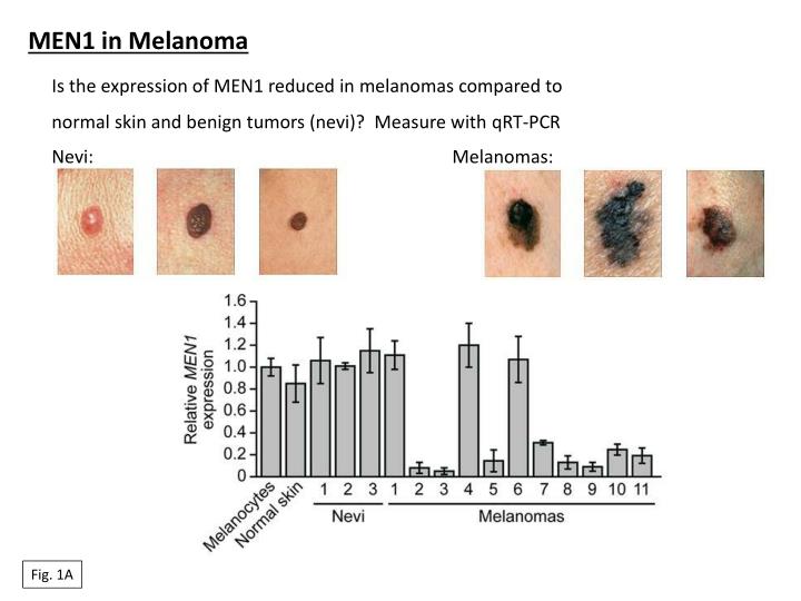 PPT - Multiple Endocrine Neoplasia type 1 (MEN1) Syndrome PowerPoint ...