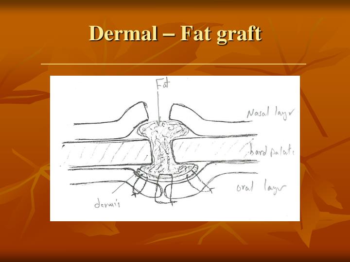 PPT - Palatal fistula PowerPoint Presentation - ID:1780032