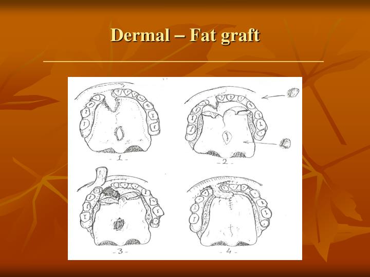 PPT - Palatal fistula PowerPoint Presentation - ID:1780032