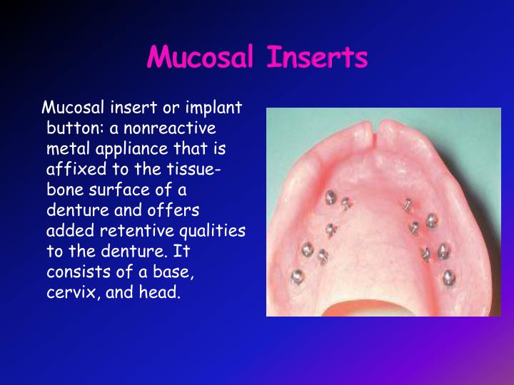 PPT - Retention, Stability & Support PowerPoint Presentation - ID:1781221