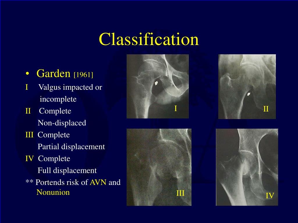 PPT - Femoral Neck Fractures Steven A. Olson, MD Original Author: Brian ...
