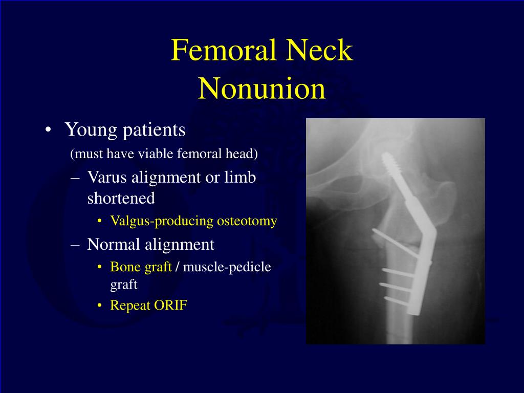 PPT - Femoral Neck Fractures Steven A. Olson, MD Original Author: Brian ...