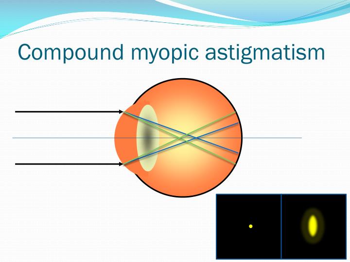 PPT - Retinoscopy PowerPoint Presentation - ID:1782161
