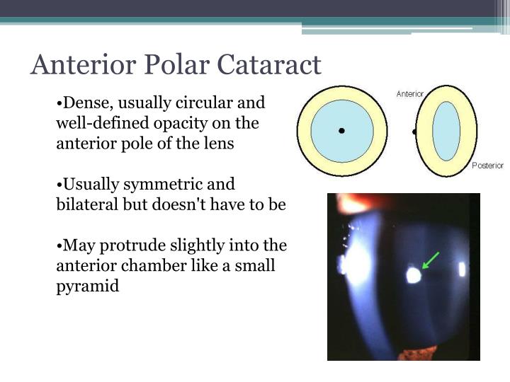 PPT - Evaluation of Paediatric Cataract PowerPoint Presentation - ID ...
