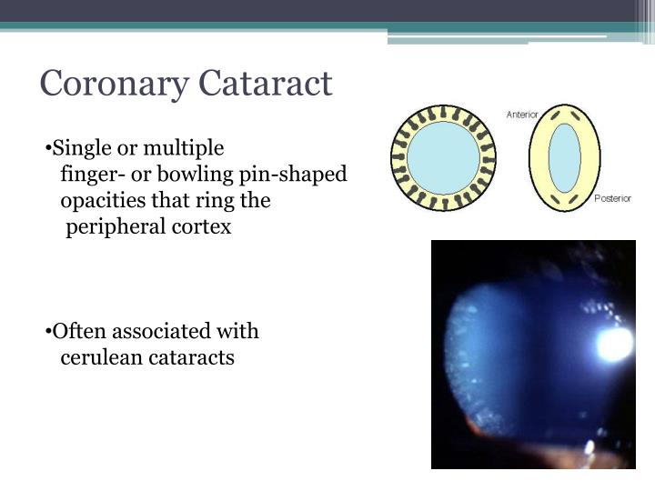 PPT - Evaluation of Paediatric Cataract PowerPoint Presentation - ID ...