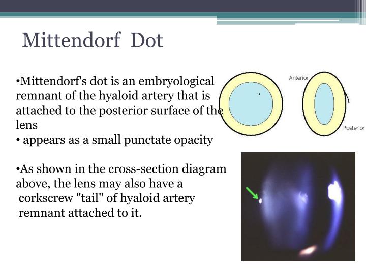 PPT - Evaluation of Paediatric Cataract PowerPoint Presentation - ID ...