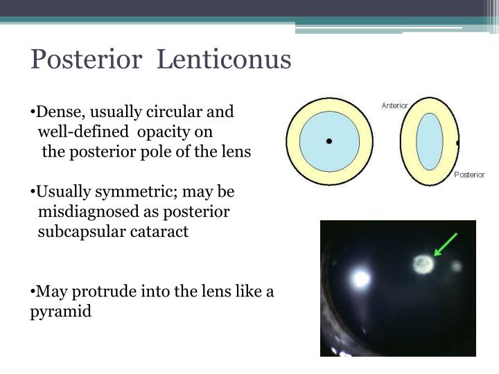 PPT - Evaluation of Paediatric Cataract PowerPoint Presentation - ID ...