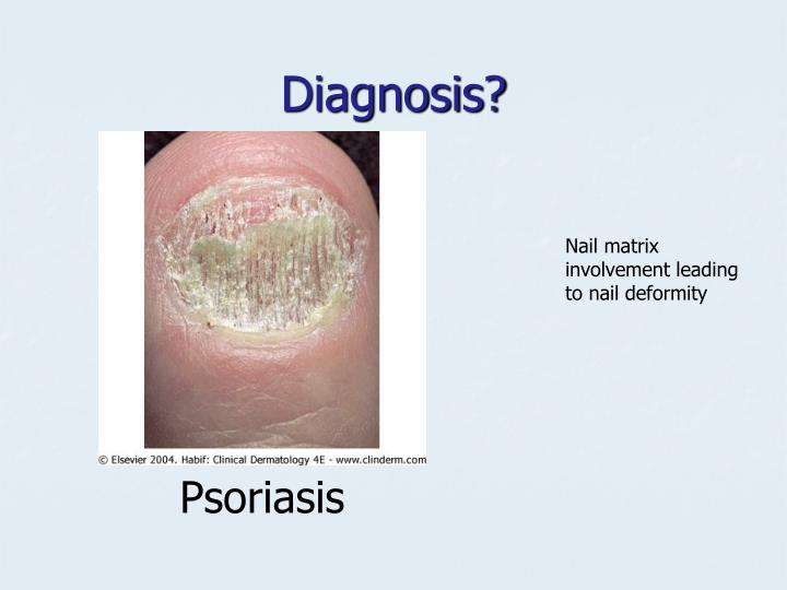 PPT - Onychomycosis PowerPoint Presentation - ID:1785081