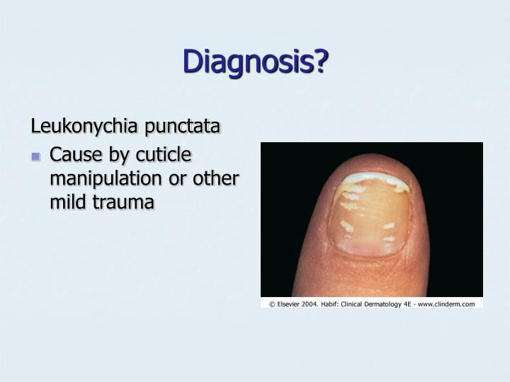 PPT - Onychomycosis PowerPoint Presentation - ID:1785081