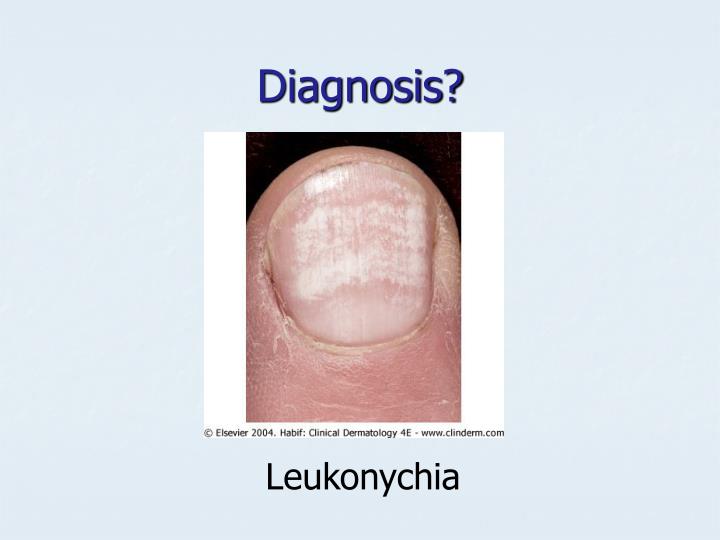 PPT - Onychomycosis PowerPoint Presentation - ID:1785081