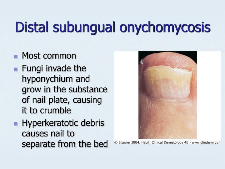 PPT - Onychomycosis PowerPoint Presentation - ID:1785081