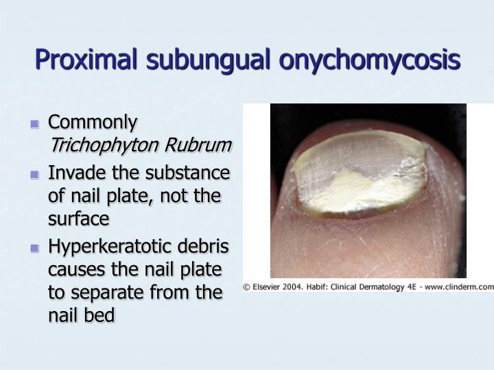 PPT - Onychomycosis PowerPoint Presentation - ID:1785081