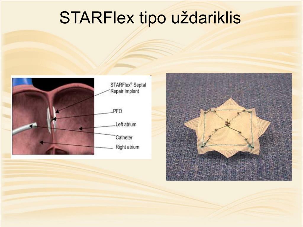 PPT - Perkutaninis Foramen Ovale (atviros ovalinės angos – AOA ...