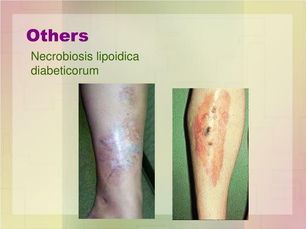 PPT - Skin manifestations of Diabetes (2006) PowerPoint Presentation ...